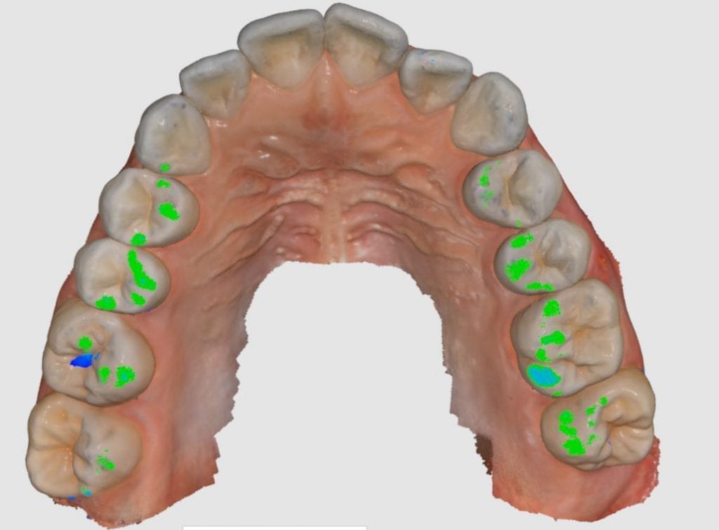 Checking Occlusion with Digital and Clinical Landmarks for a Clear ...