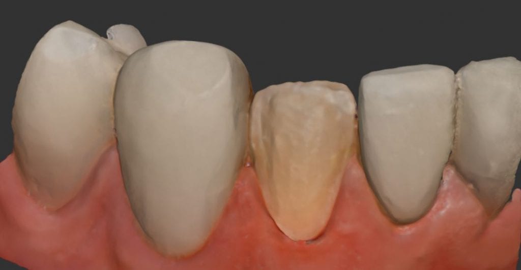 venner prep | CAD-Ray.com