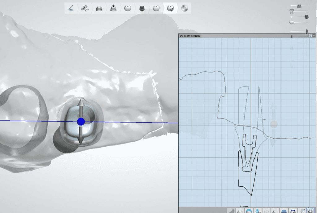 metal abutment from scan body by medit | CAD-Ray.com
