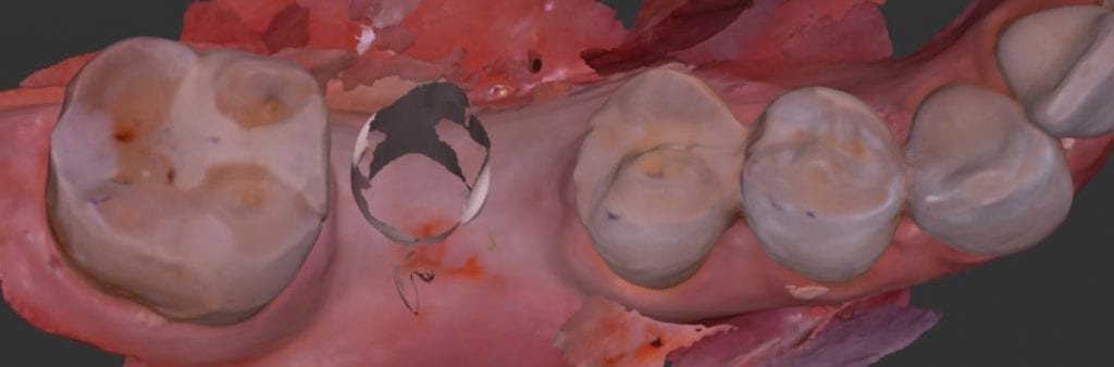 Scanbody Morphed Cad Ray