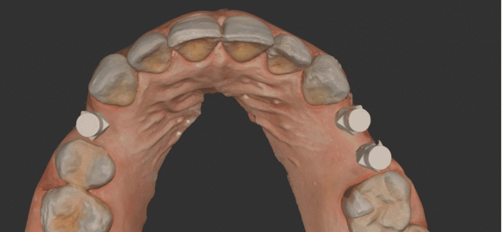 Three implants one DESS scanbody image with medit i500 | CAD-Ray.com