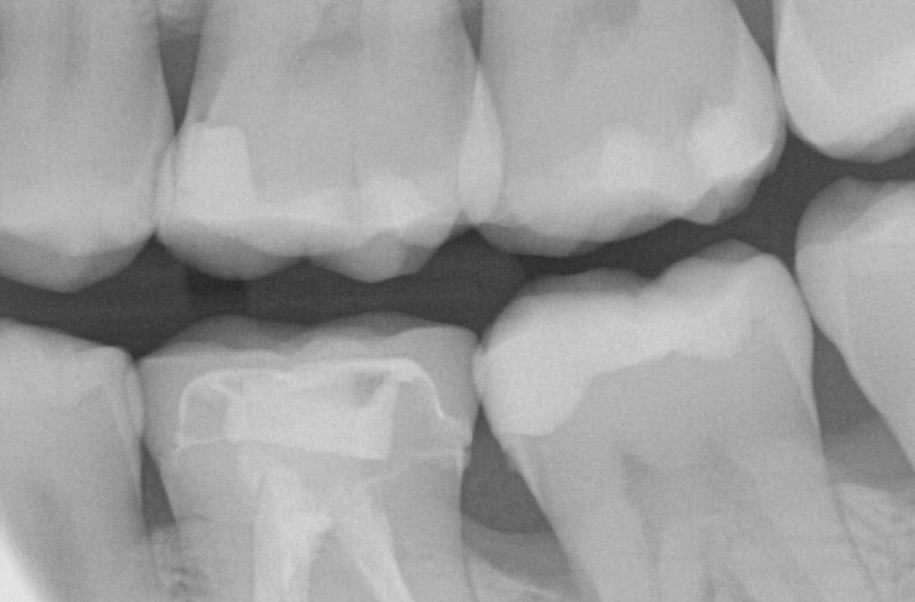 First Molar Crown Margins by Medit i500 and exocad | CAD-Ray.com