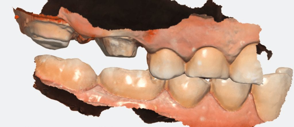first way to do consecutive crowns | CAD-Ray.com