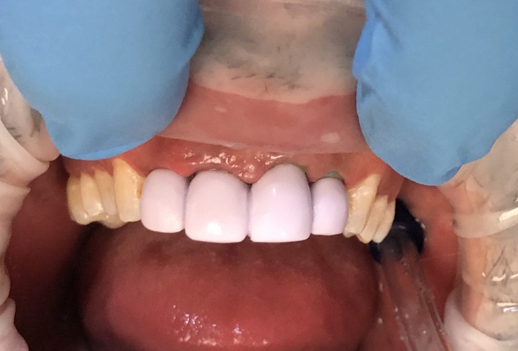 Four Unit Anterior eMax Bridge with Medit i500, exocad, and Z4 Milling ...