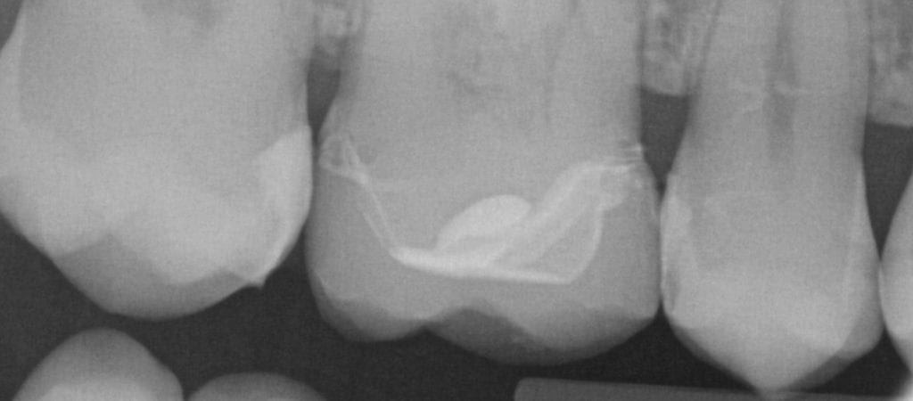 Upper First Molar Restored with Medit i500, exocad, emax, and VHF Z4 ...