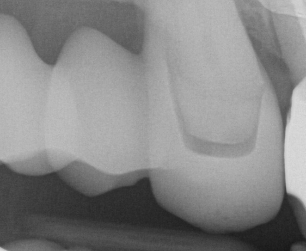 Milling a 4 Unit eMax Bridge With The Imes Icore CORiTEC ONE | CAD-Ray.com