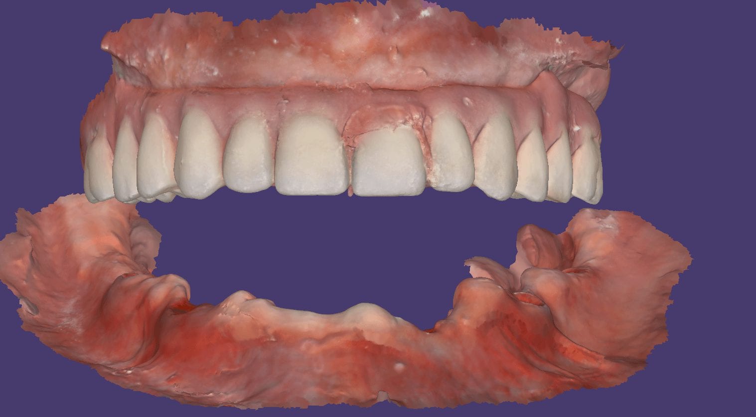 How To Scan An Edentulous Lower Arch in 90 Seconds With Great Accuracy ...