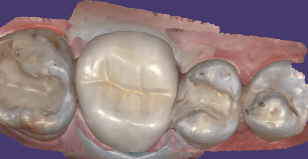 Reliability Map Scanning for Advanced Users and Chairside Restorations ...