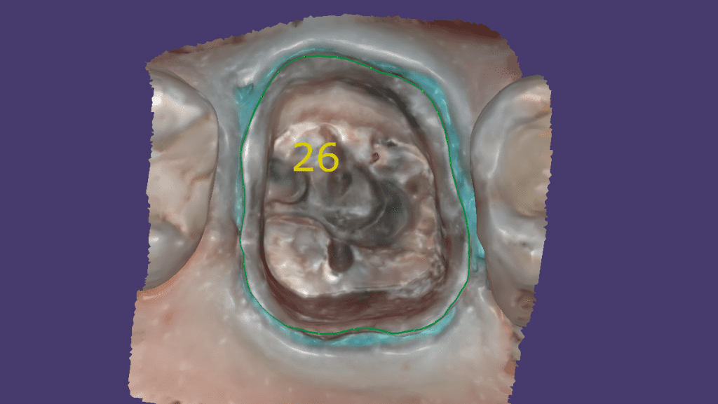 Reliability Map Scanning for Advanced Users and Chairside Restorations ...