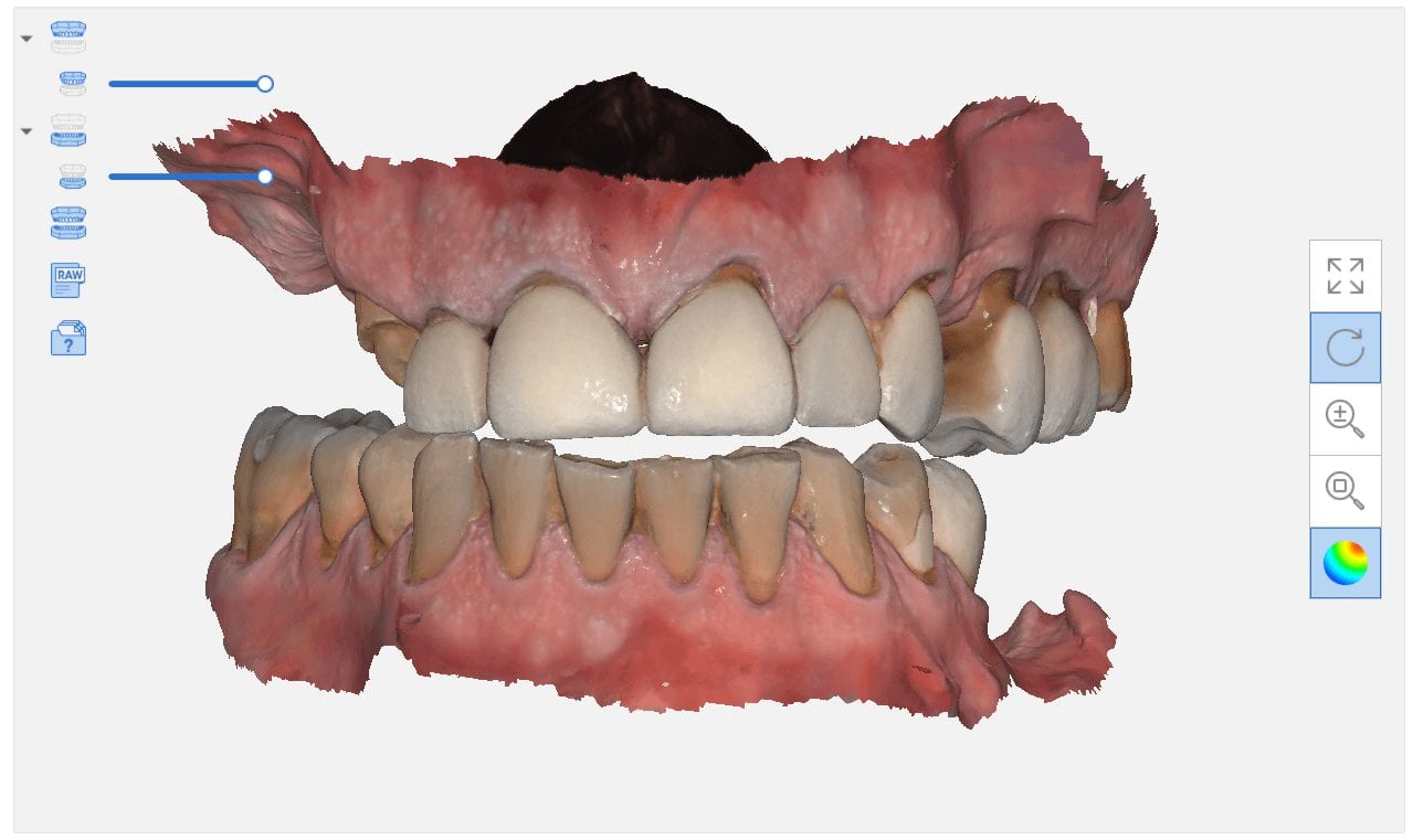 Digital Full Mouth Reconstruction with Implants and Opening of Vertical ...