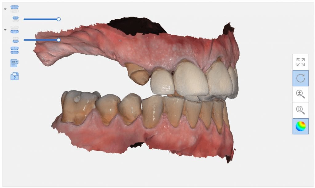 fmr implants new bite right | CAD-Ray.com