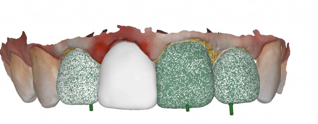 Three Unit Bridge and A Single Unit Veneer Milled with 40 mm Emax Block ...