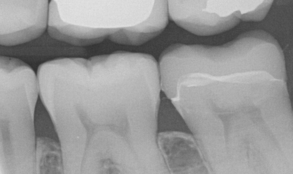 Full Coverage Crown on a Fractured Second Molar and Two Bites | CAD-Ray.com