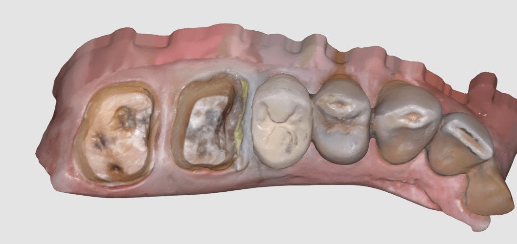 A Pair Of Molar Crowns With Medit i500, exocad Designs, And Milled With ...