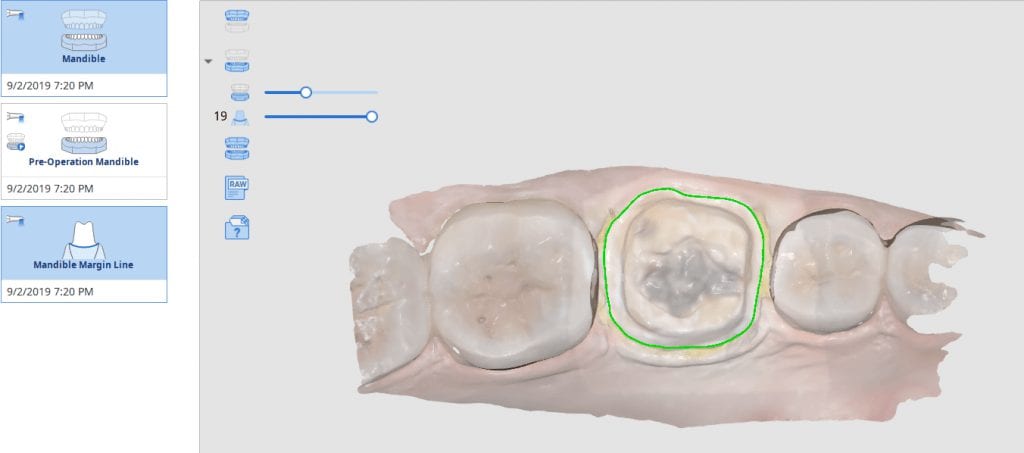 download the case for medit margin line detection | CAD-Ray.com