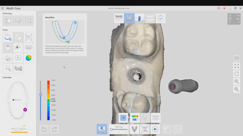 load-bsb-abutment-mp4-5 | CAD-Ray.com