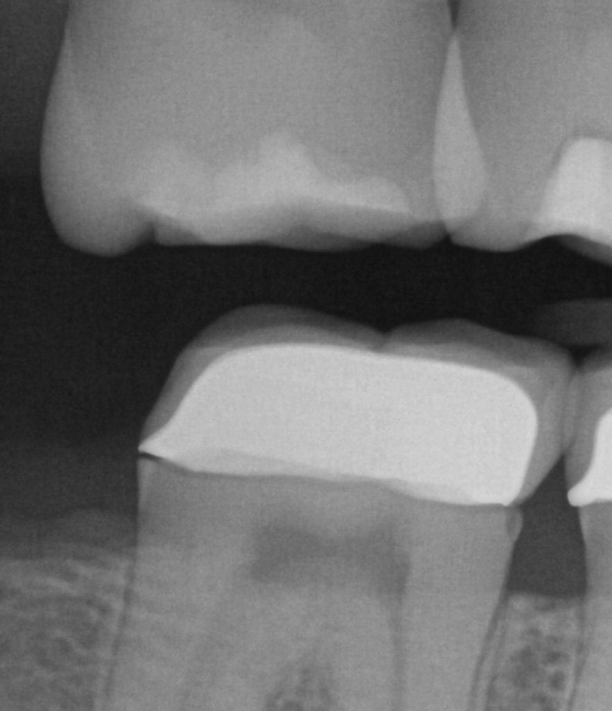 Second Molar Crown Replacement in Copy Mode | CAD-Ray.com