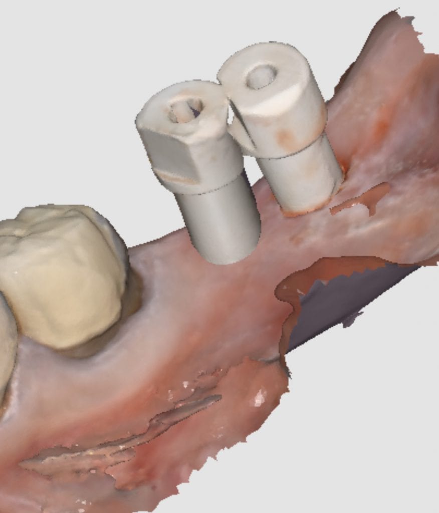 Implants and Digital Impressions | CAD-Ray.com