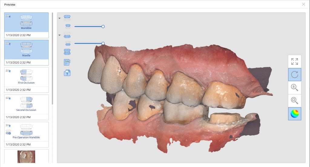 second molar | CAD-Ray.com