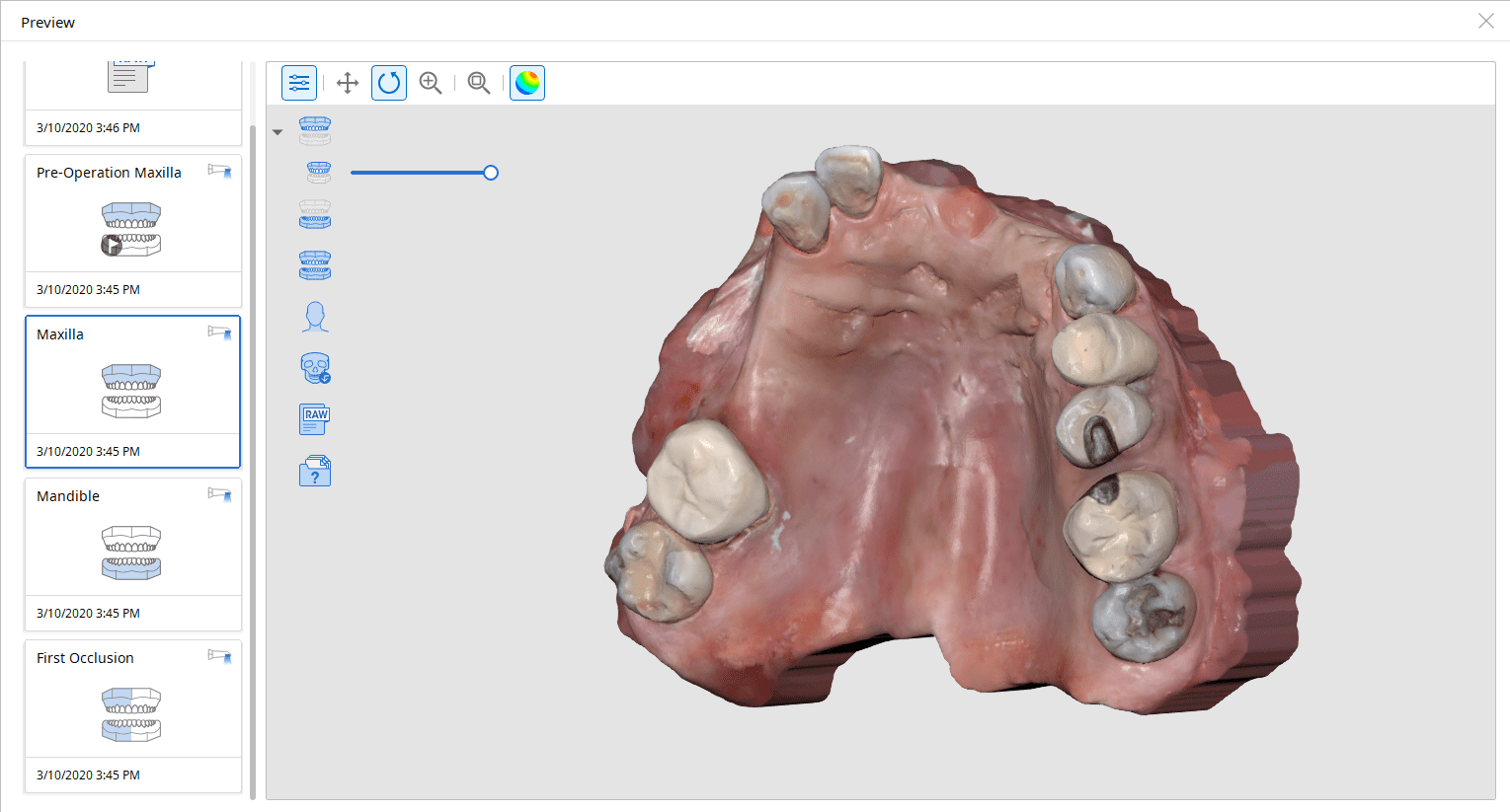 Copy a Partial Denture Onto an Edentulous Arch | CAD-Ray.com
