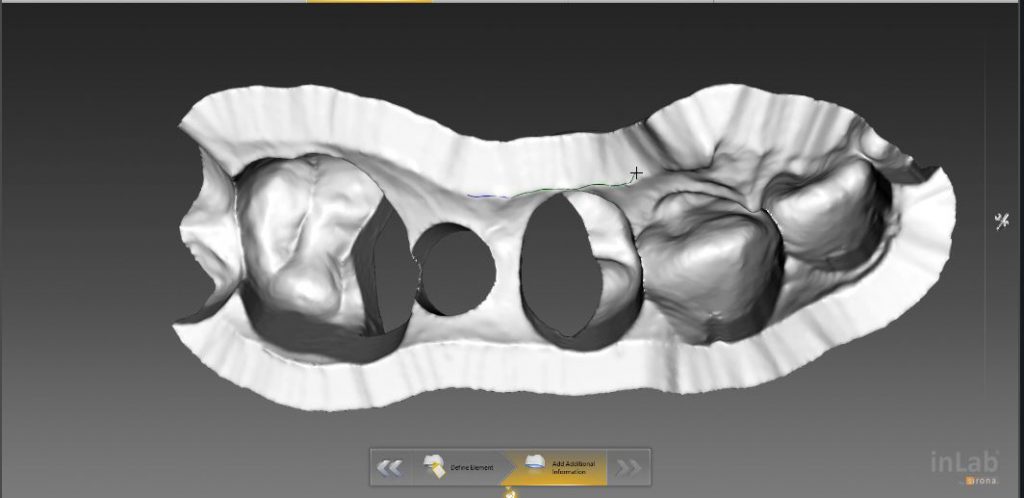 Milling Tibase Crowns to CEREC MCXL with a Medit Scan and exocad design ...