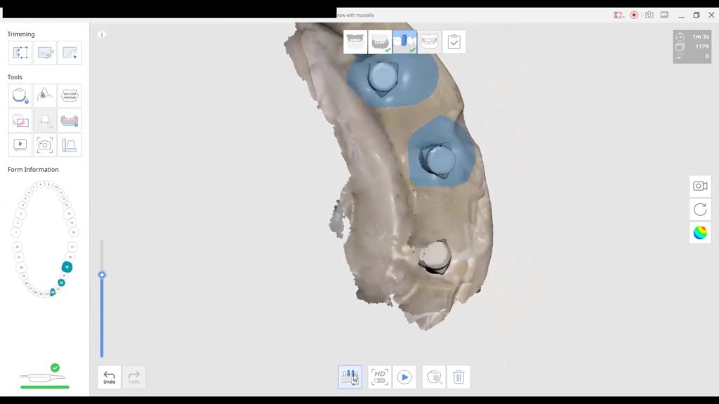 Common Problems With Scanning Multiple Implant Scanbodies | CAD-Ray.com