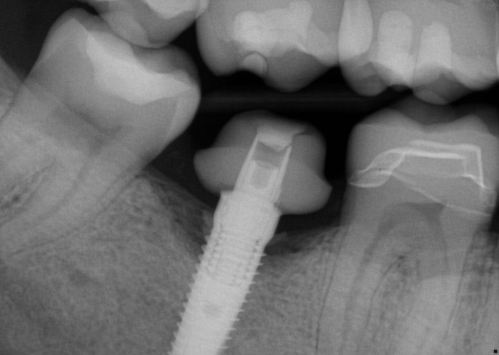 Saving an Integrated Implant by Treating it as a Cast Post and Core by ...