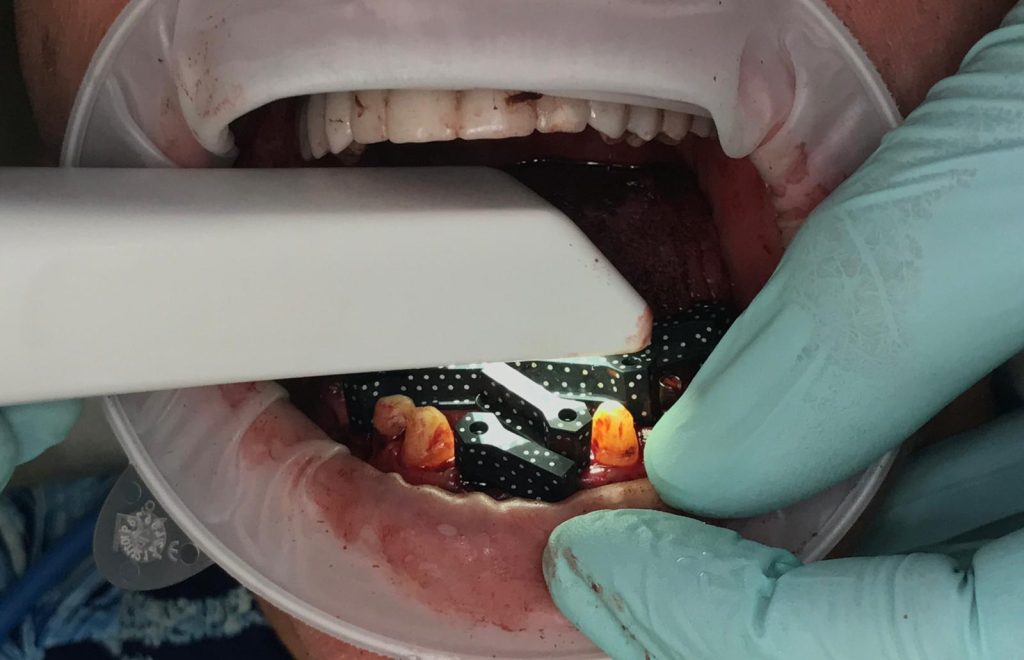 Shining3D Aoralscan Elite IOS + Intraoral Photogrammetry | CAD-Ray.com